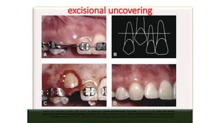 surgical and orthodontic management of impacted maxillary caninespart 1 ...
