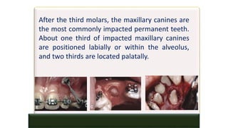 surgical and orthodontic management of impacted maxillary caninespart 1 ...