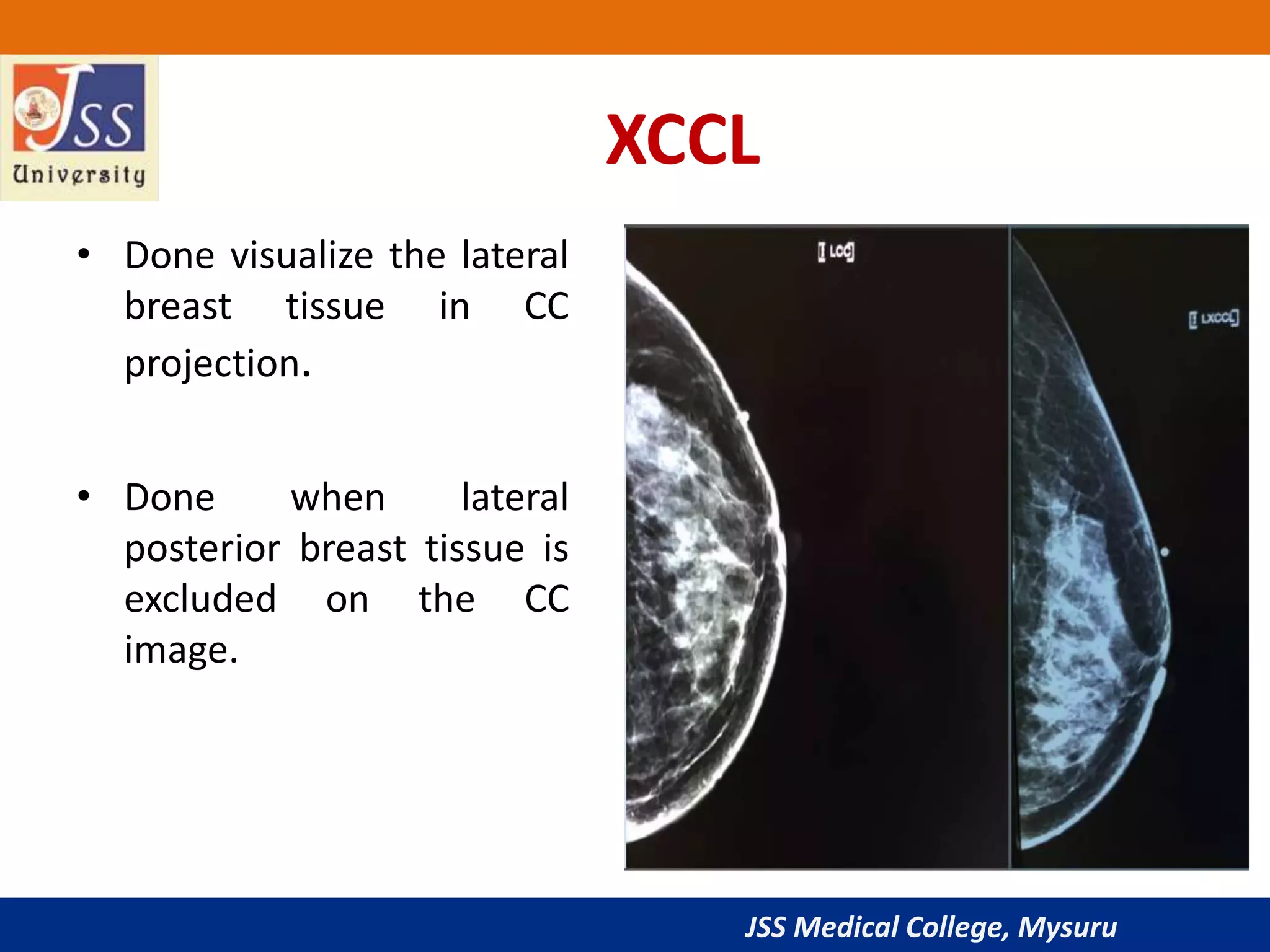 Mammography technique | PPTX