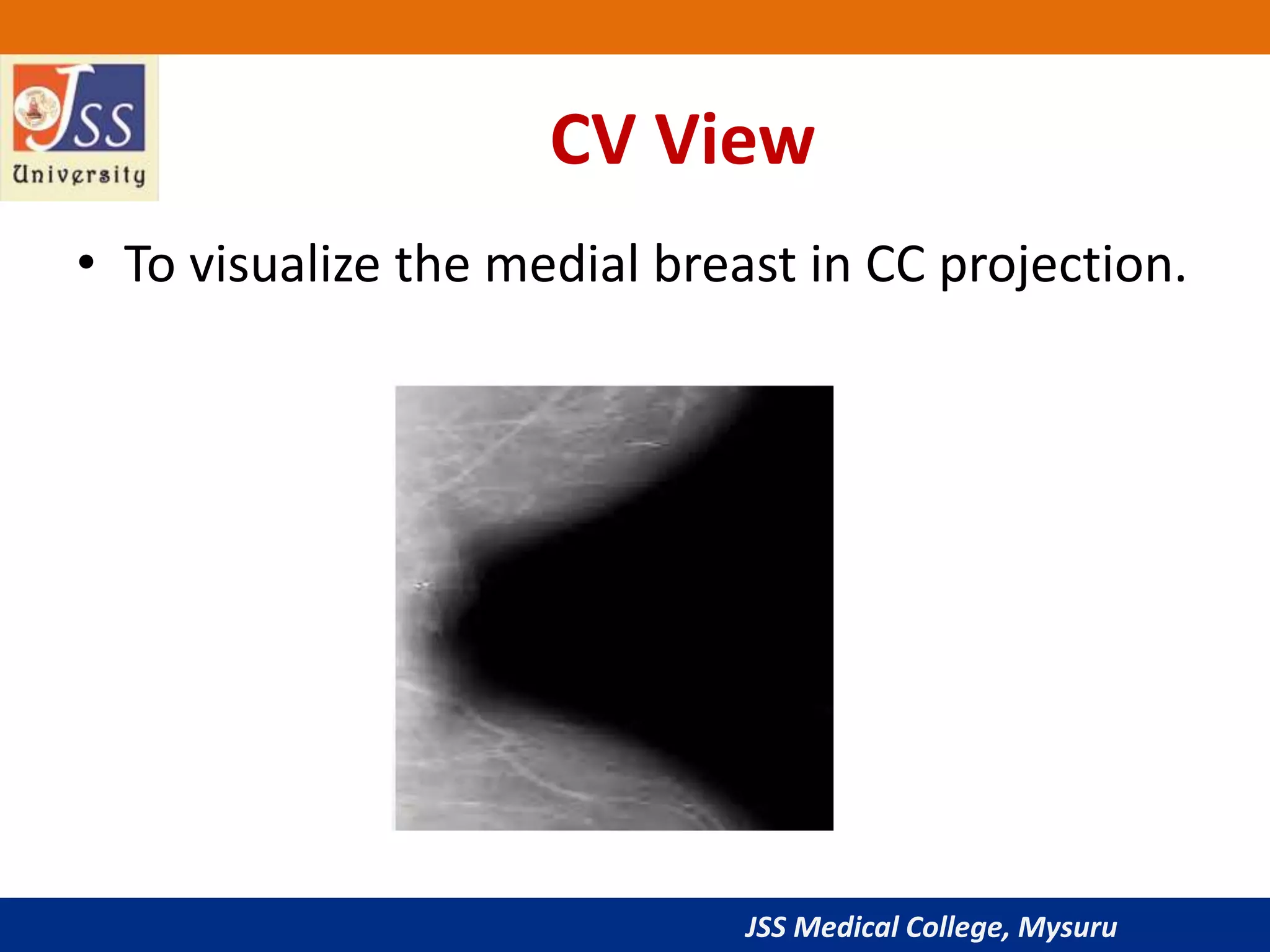 Mammography technique | PPTX