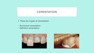 Preparation of tooth-surface before cementation | PPTX