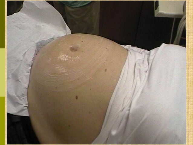 methods of Chromosomal Evaluation in Amniocentesis- Define, Time for ...
