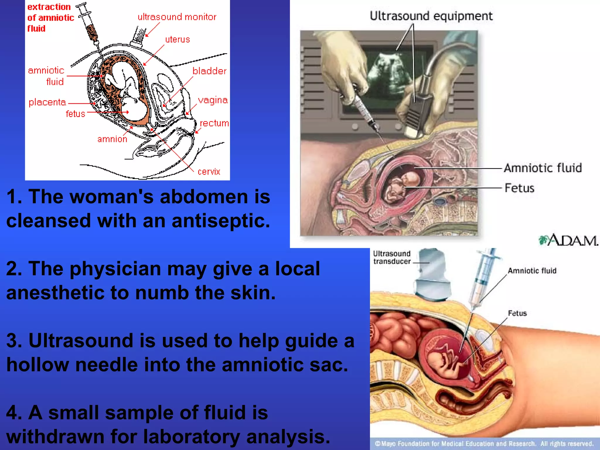 Amniocentesis ((Slide Show)) | PPT