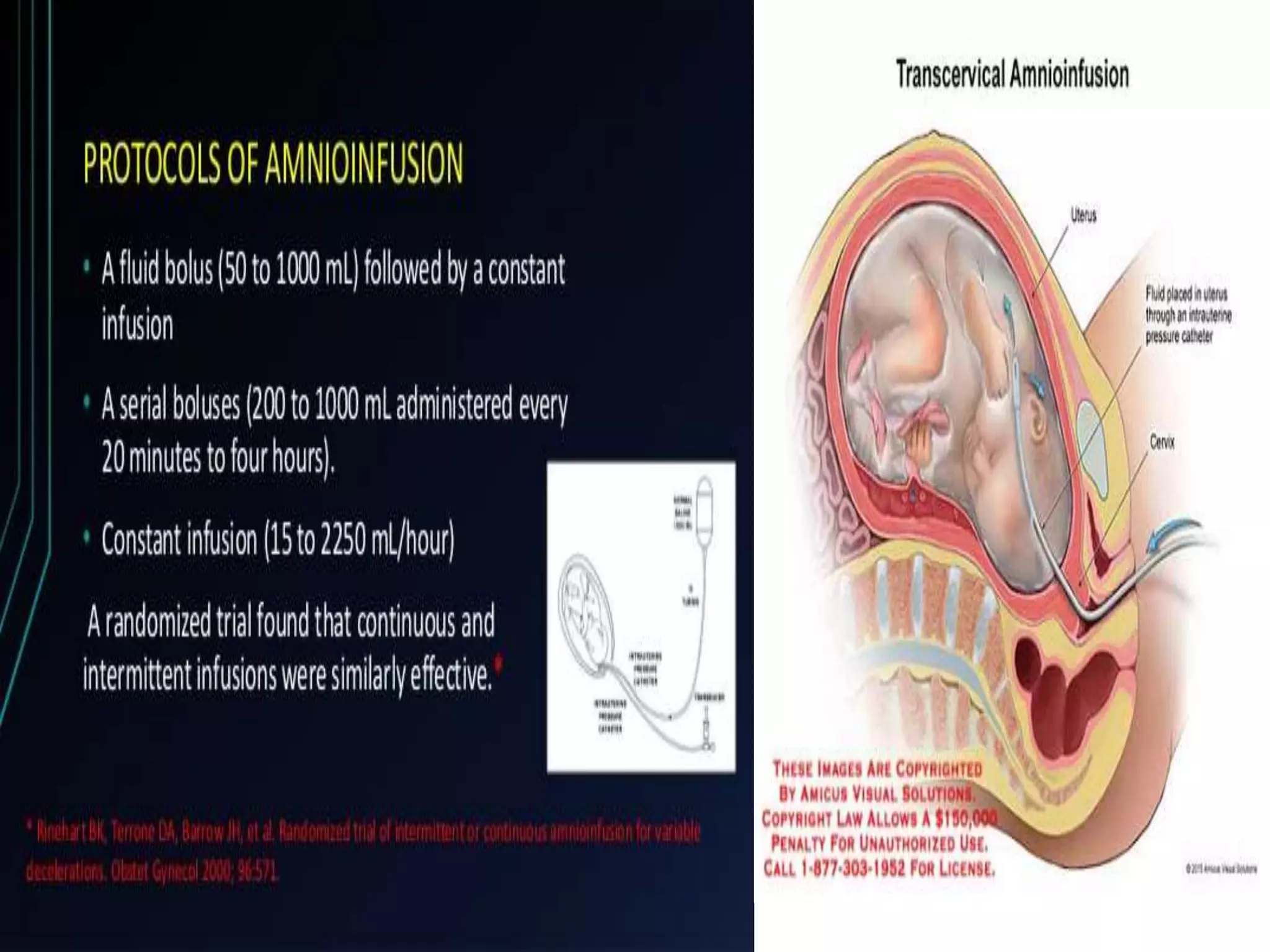Amnioinfusion | PPTX