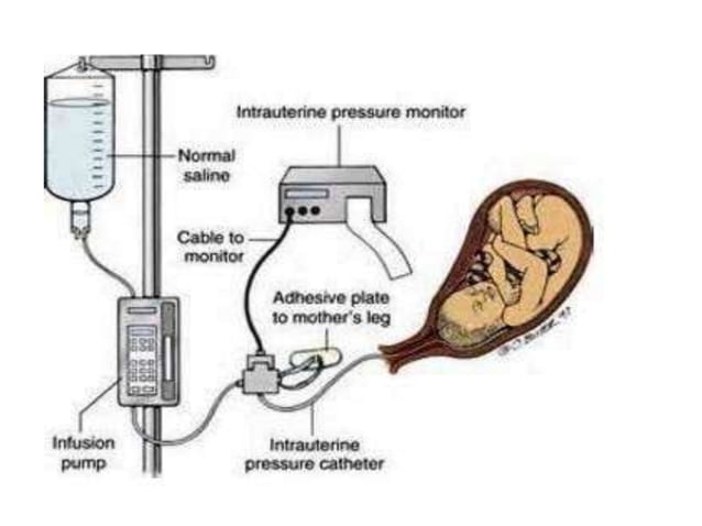 Amnioinfusion | PPTX | First Aid | Injuries