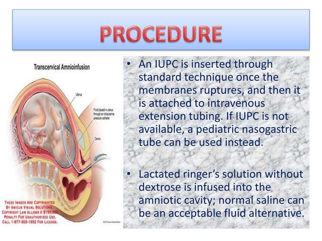 Amnioinfusion | PPTX | First Aid | Injuries