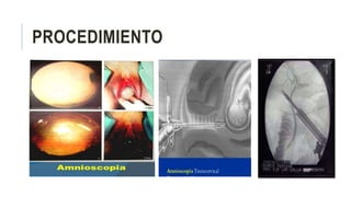 Amnioscopia | PPTX