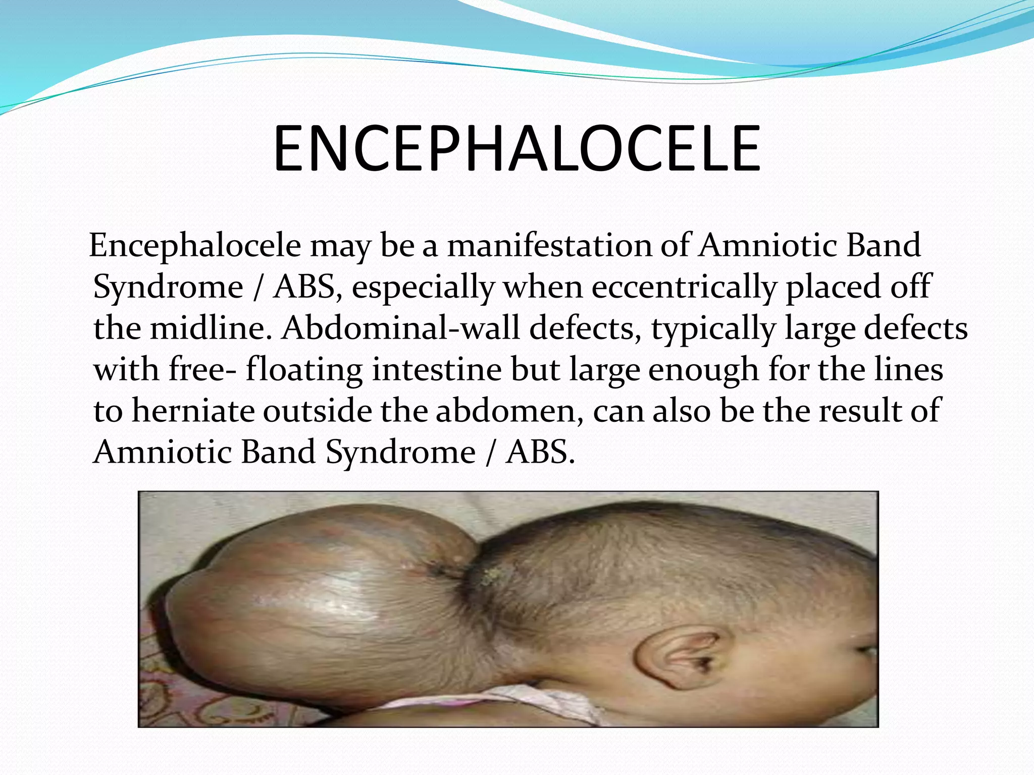 Amniotic band syndrom epptx | PPTX