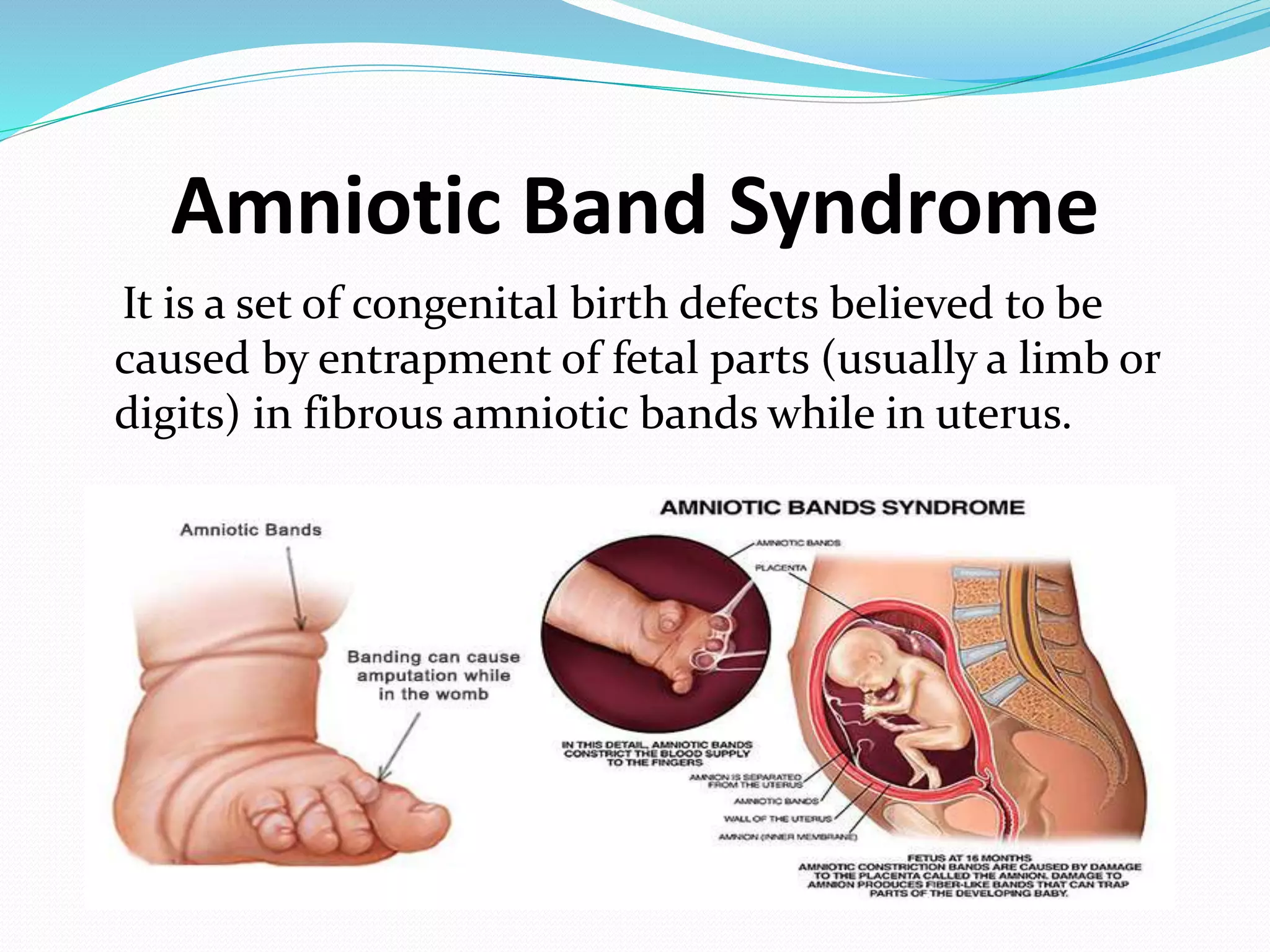 Amniotic band syndrom epptx | PPTX