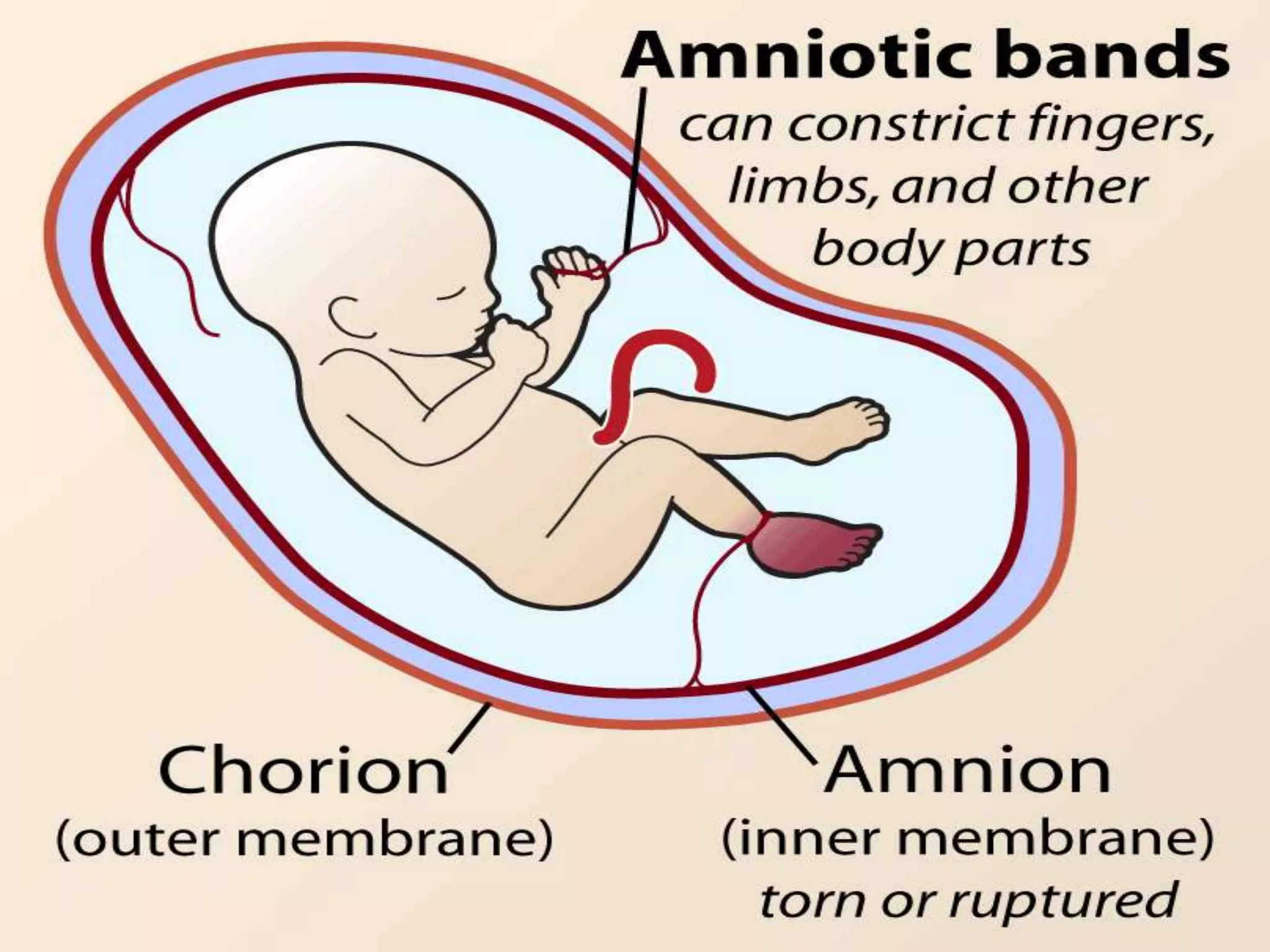 Amniotic band syndrom epptx | PPTX