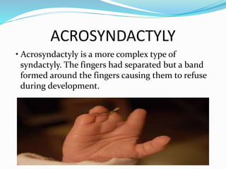 Amniotic band syndrom epptx | PPTX