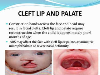 Amniotic band syndrom epptx | PPTX