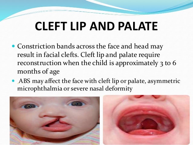 Amniotic Band Syndrom Epptx