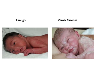 Vernix Caseosa And Lanugo