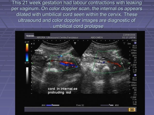 Amniotic fluid ultrasound | PPT | Pregnancy | Reproductive Health