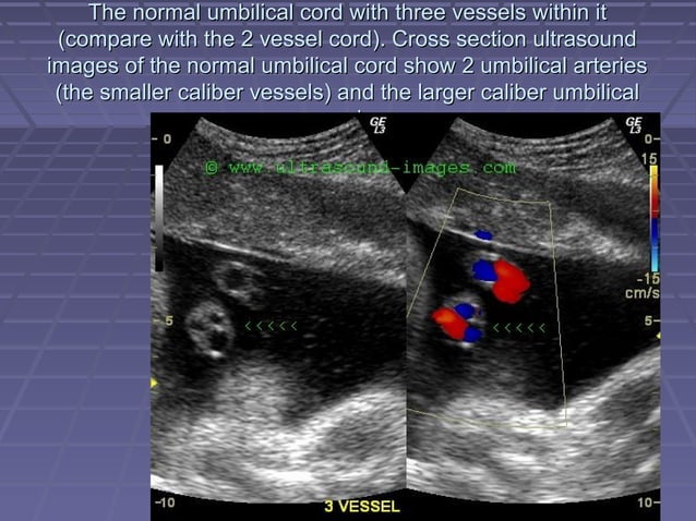 Amniotic fluid ultrasound | PPT | Pregnancy | Reproductive Health