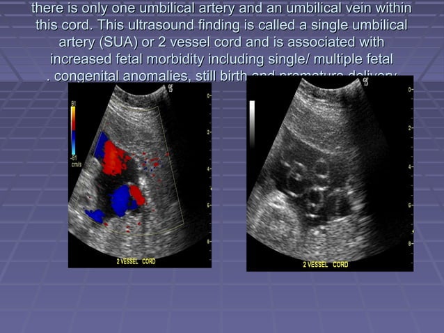 Amniotic fluid ultrasound | PPT | Pregnancy | Reproductive Health