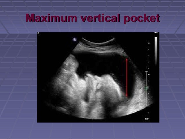 Amniotic fluid ultrasound