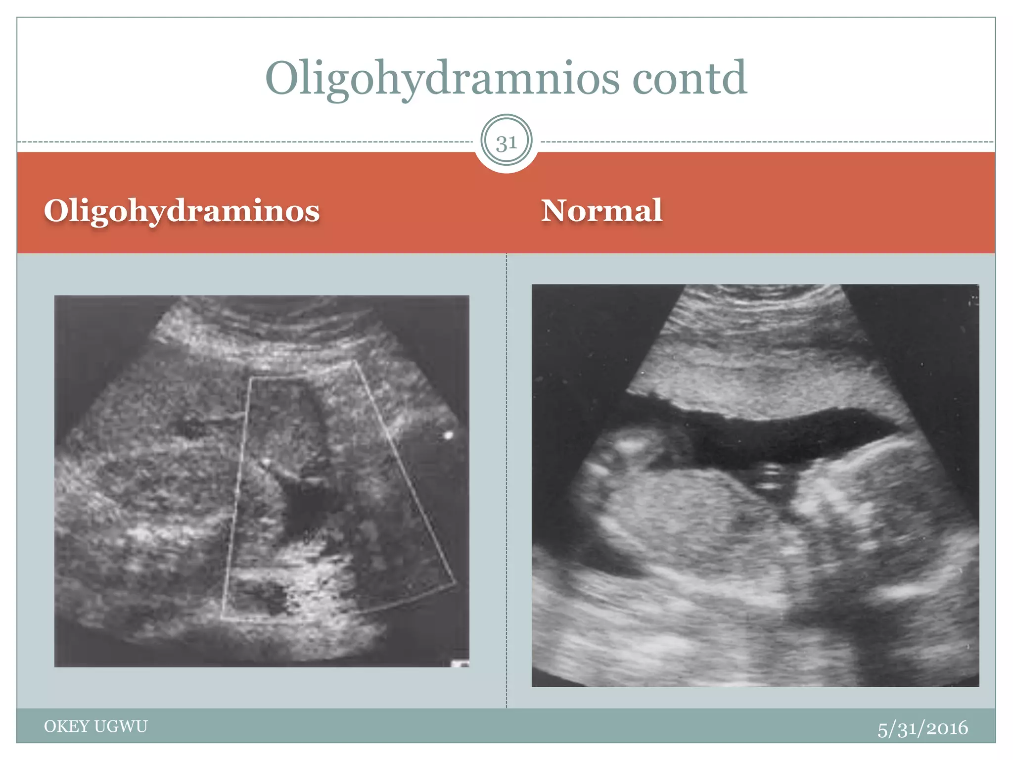 Amniotic fluid disorders | PPTX