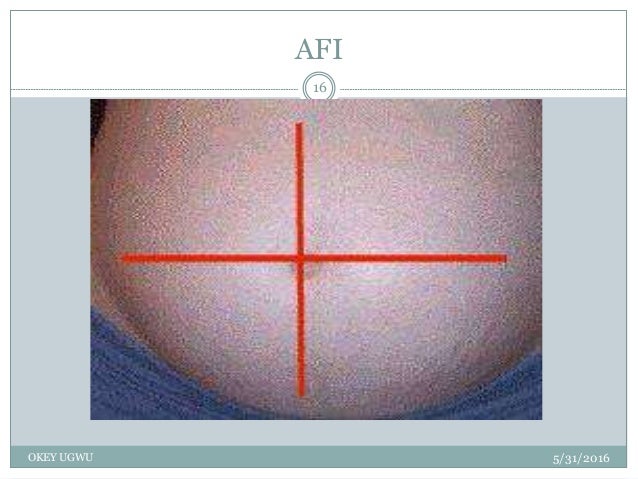 Amniotic fluid disorders