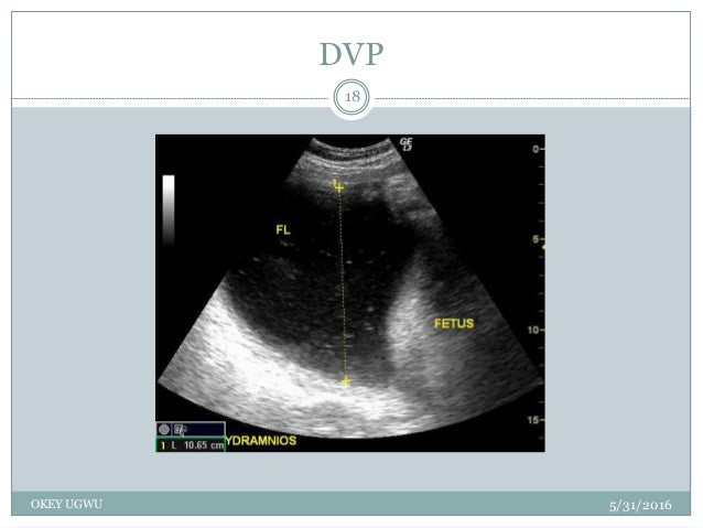 Amniotic fluid disorders