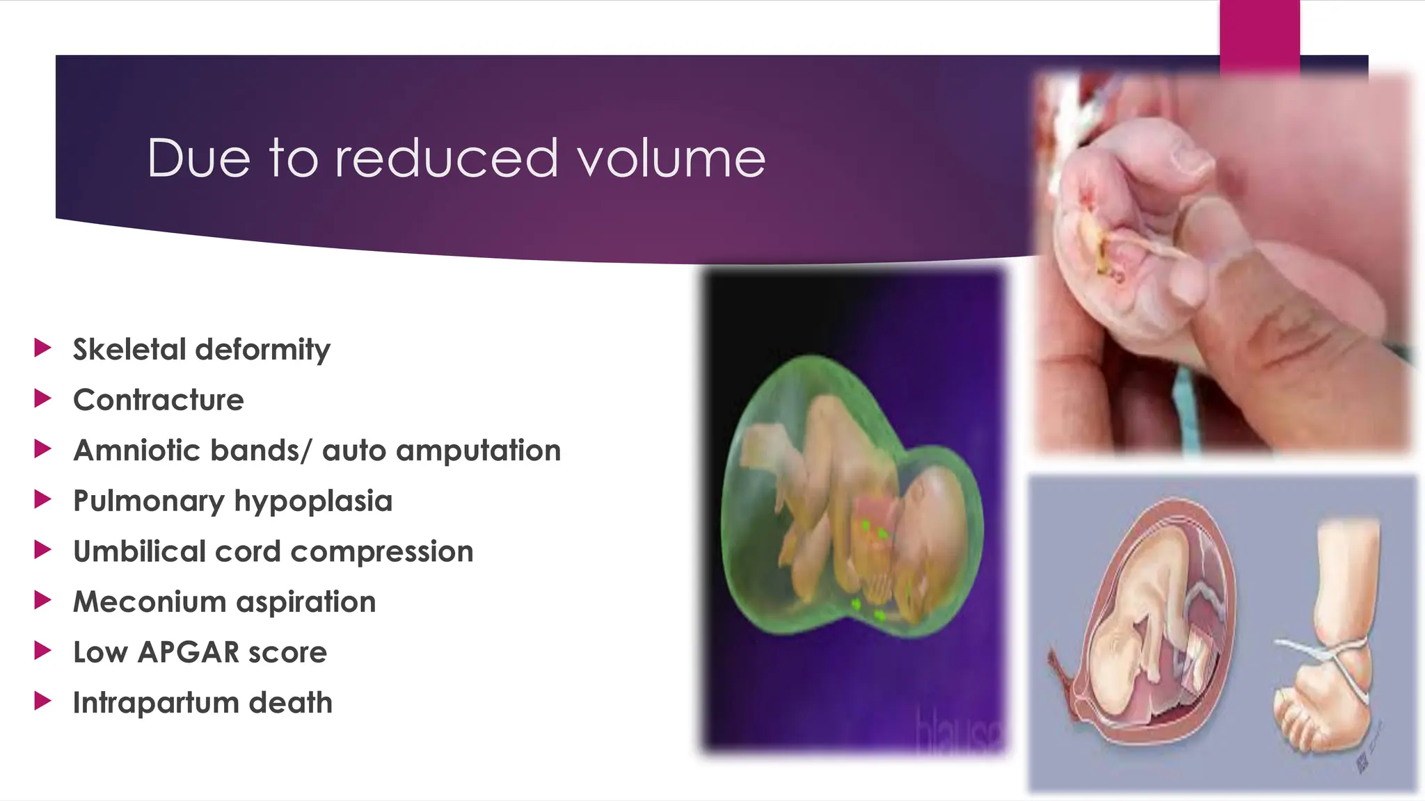amniotic fluid disorders Presentation (1).pptx