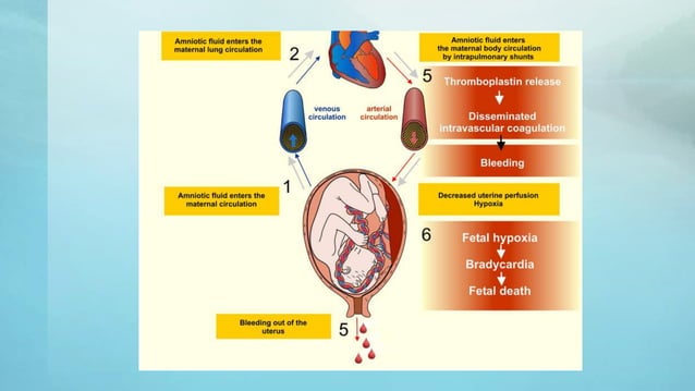 Amniotic fluid embolism | PPT