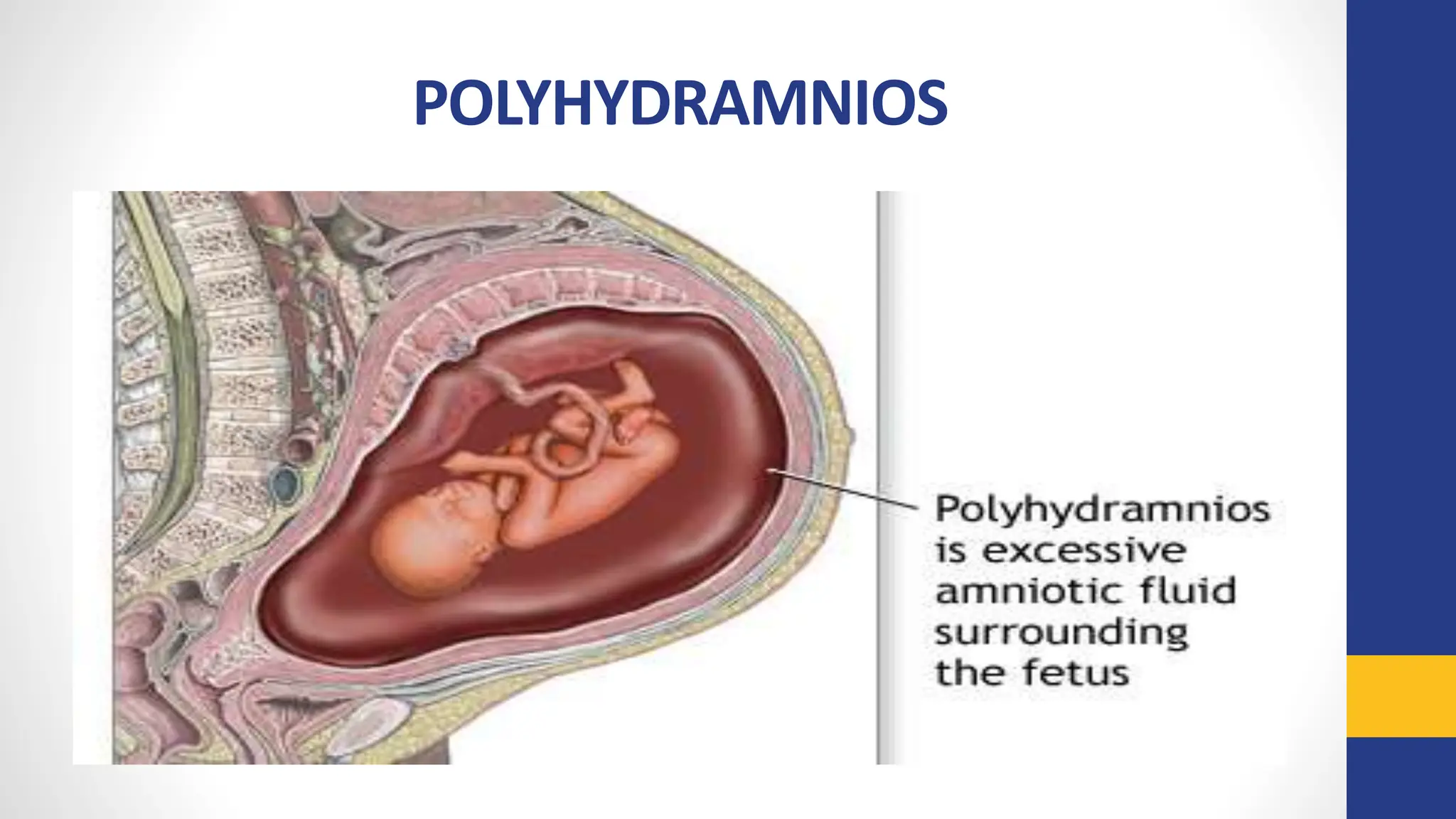 polyhydramnios and oligohydramnios.pptx