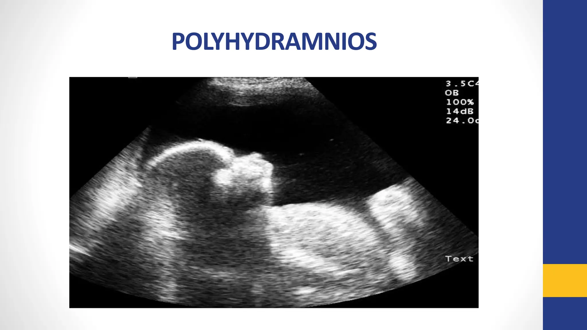 polyhydramnios and oligohydramnios.pptx