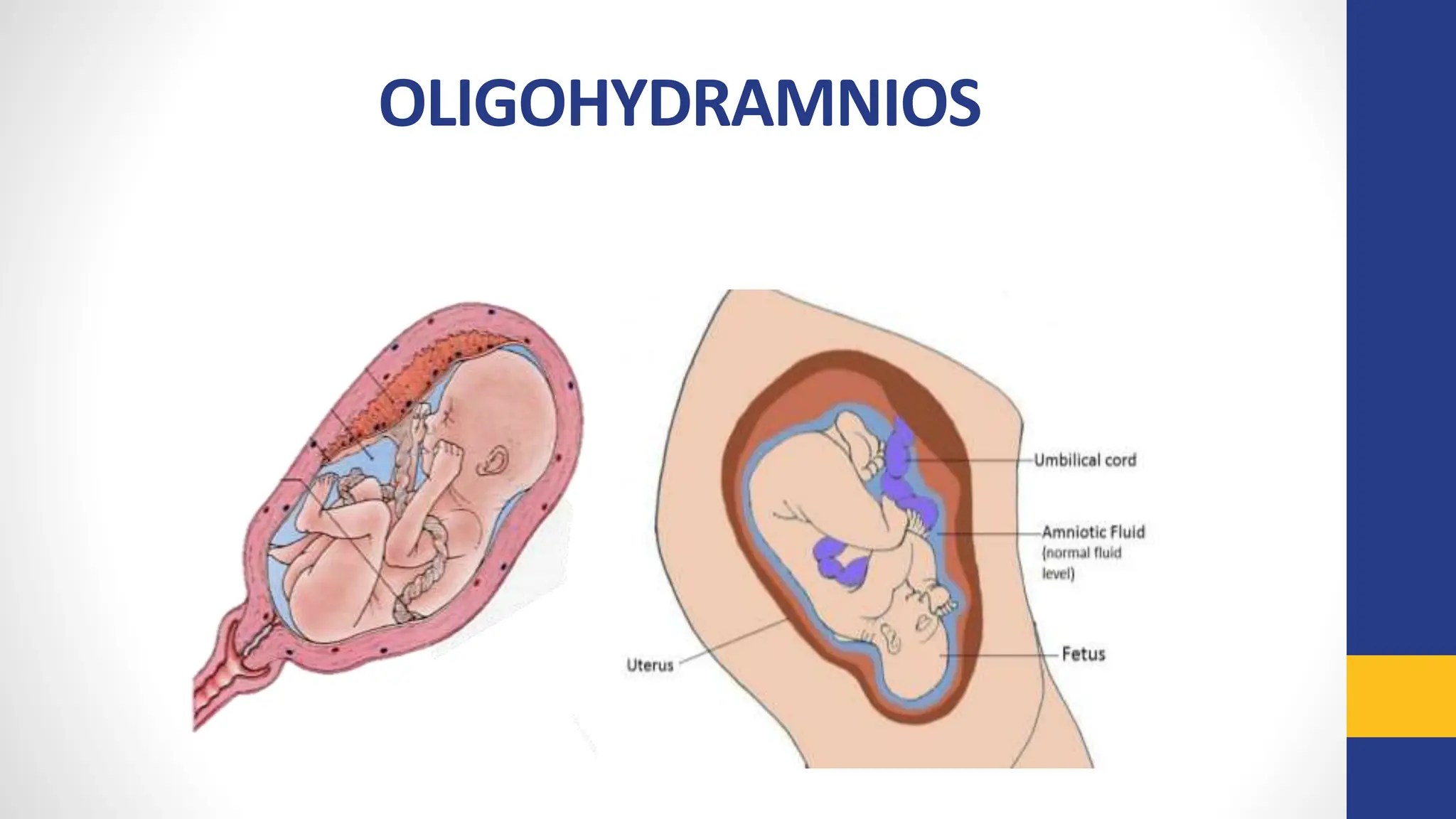 polyhydramnios and oligohydramnios.pptx