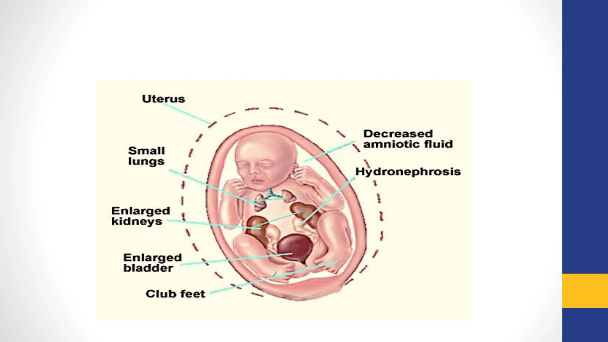polyhydramnios and oligohydramnios.pptx