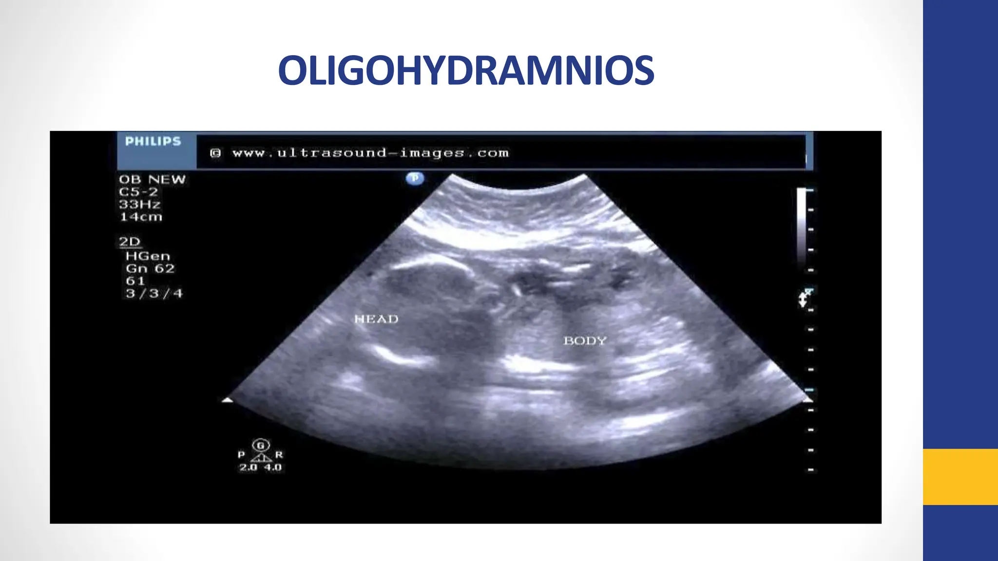 polyhydramnios and oligohydramnios.pptx