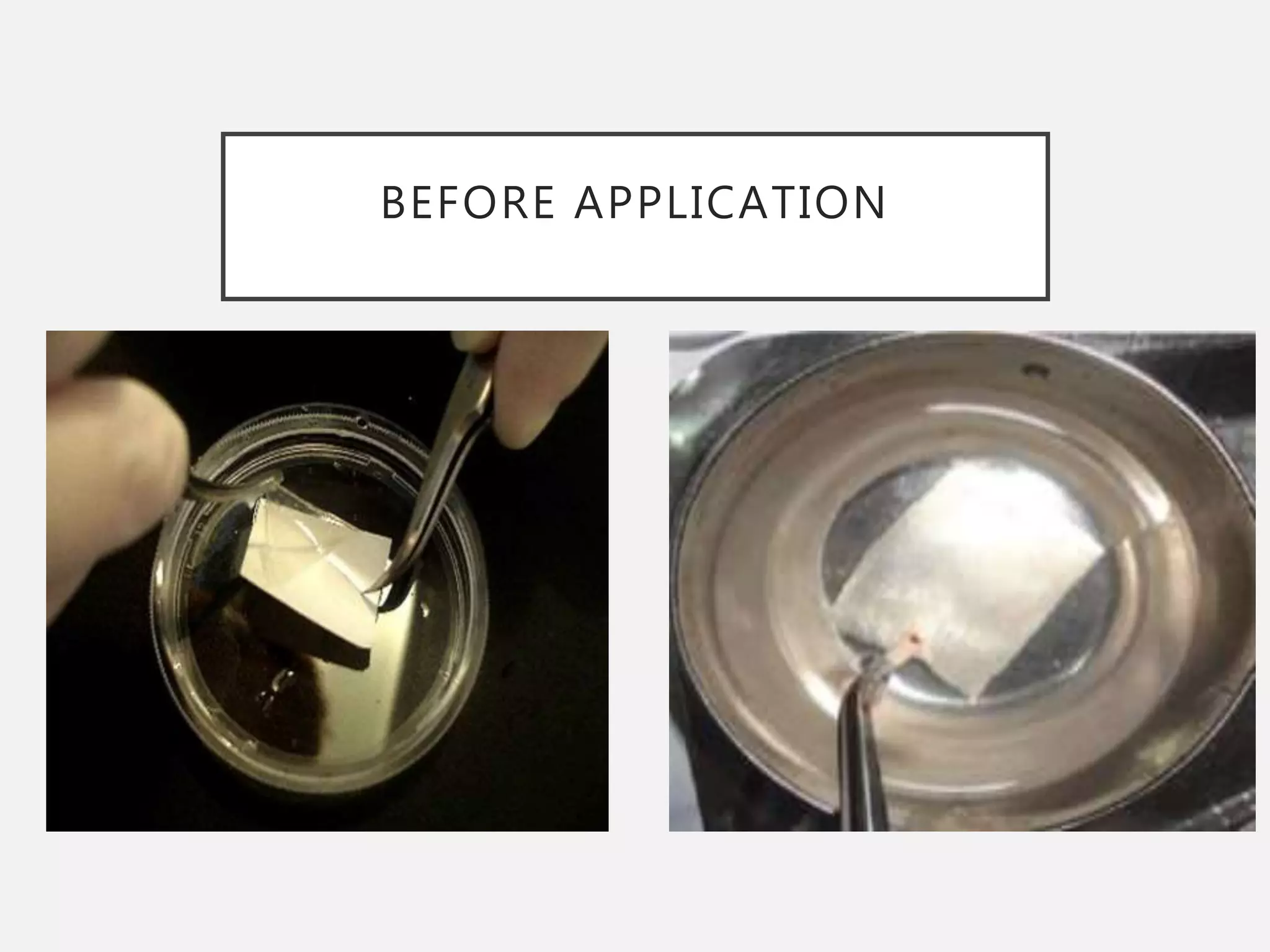 Amniotic membrane in ophthalmology | PPTX