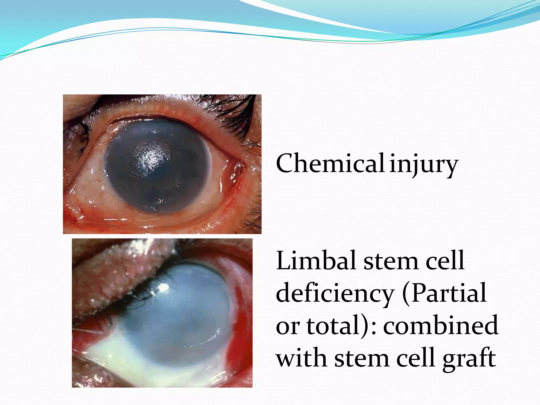 Amniotic Membrane Transplant | PPTX