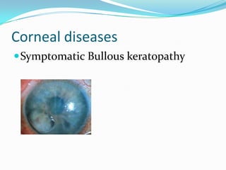 Amniotic Membrane Transplant | PPTX