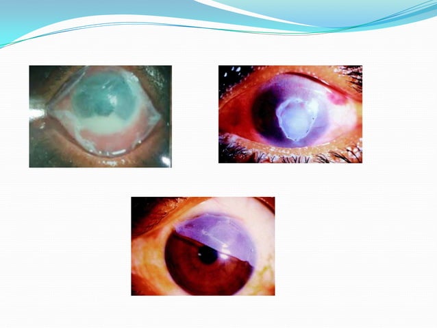 Amniotic Membrane Transplant | PPTX | Pregnancy | Reproductive Health