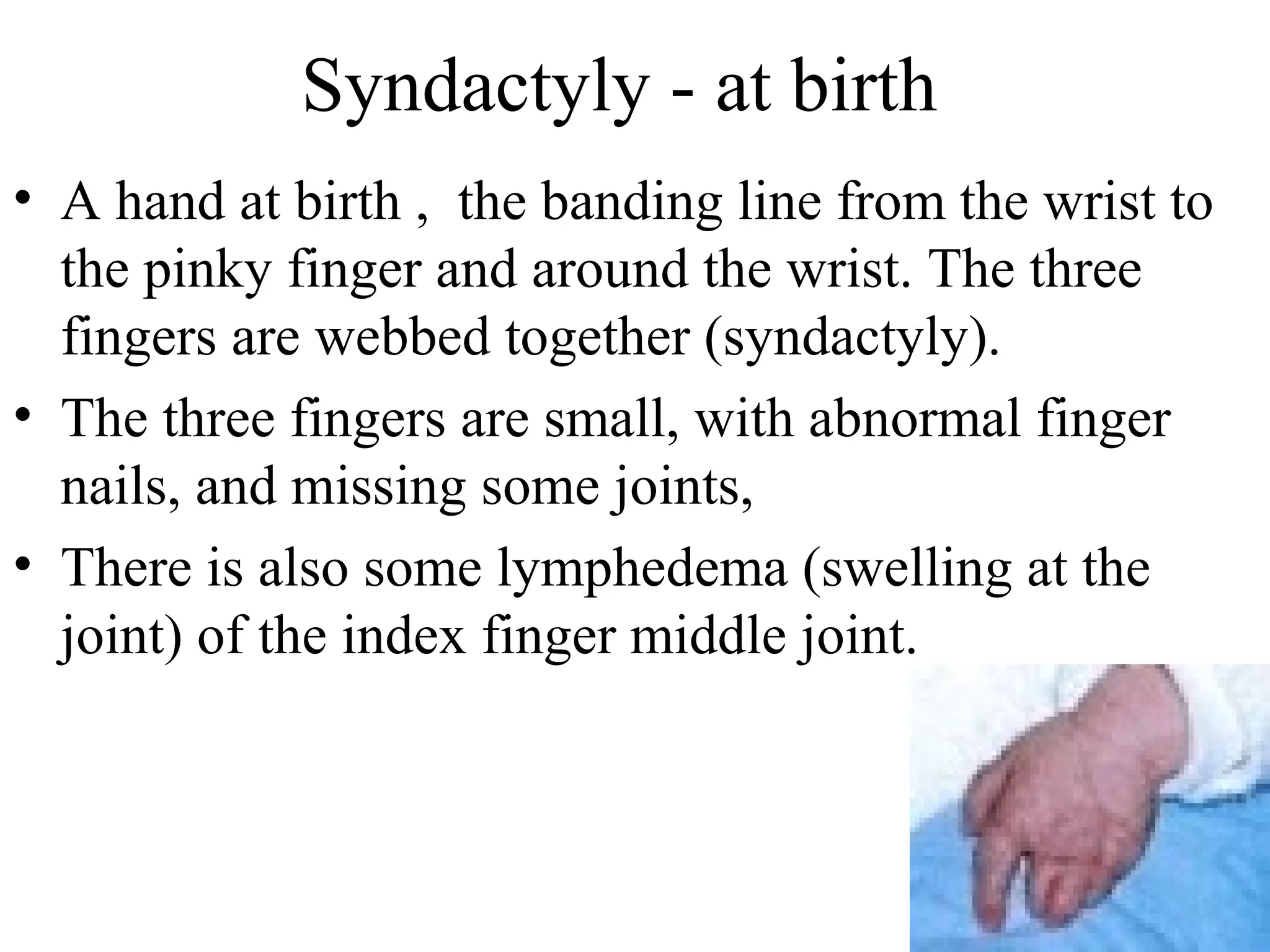 Amniotisbandsyndrome | PPT