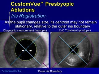 Amo presbyopia training course | PPT