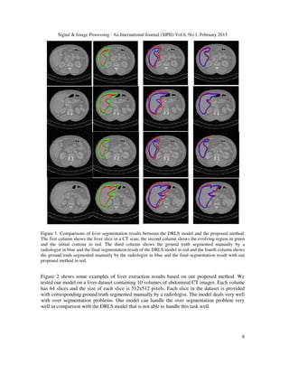 A modified distance regularized level set model for liver segmentation from ct images | PDF