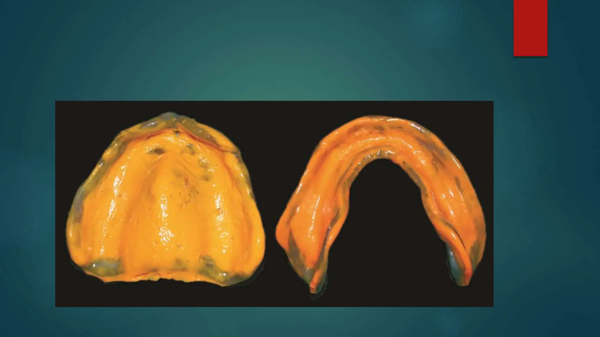 A MODIFIED TECHNIQUE FOR SINGLE STEP BORDER MOLDING.pptx