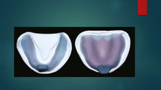 A MODIFIED TECHNIQUE FOR SINGLE STEP BORDER MOLDING.pptx