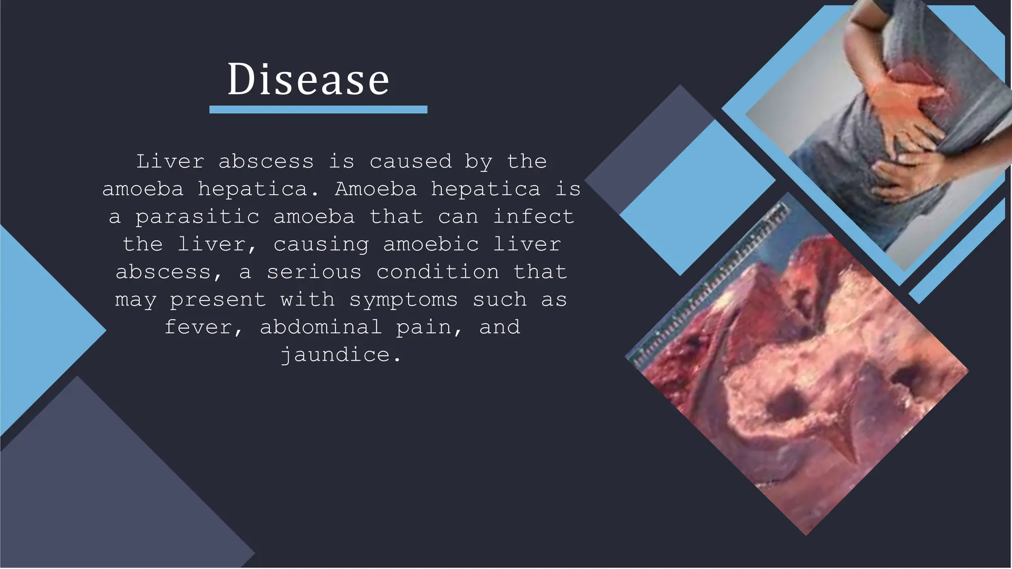 Amoeba Hapatica presentation by Ayesha Khan.pptx