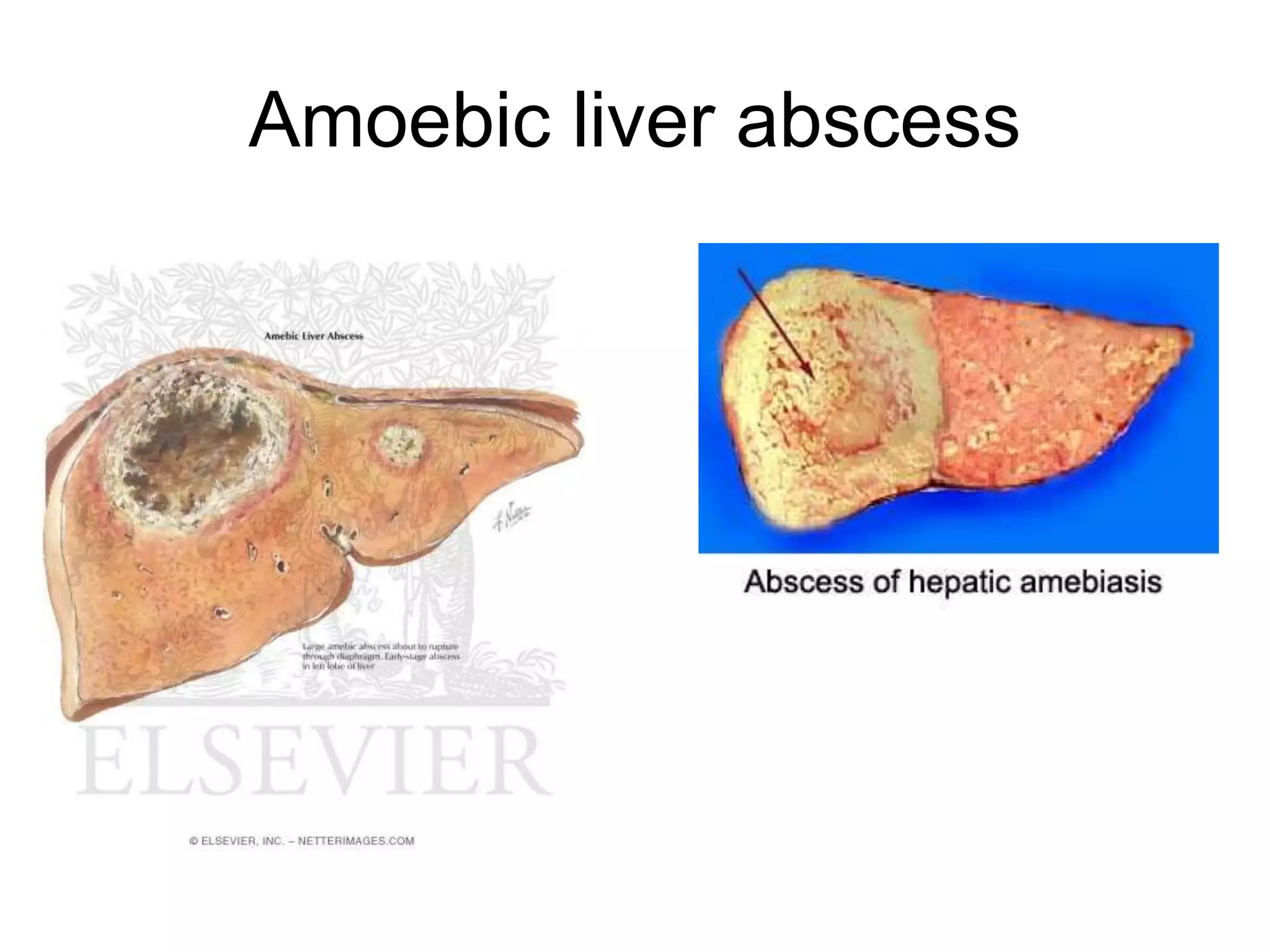Amoebiasis | PPTX