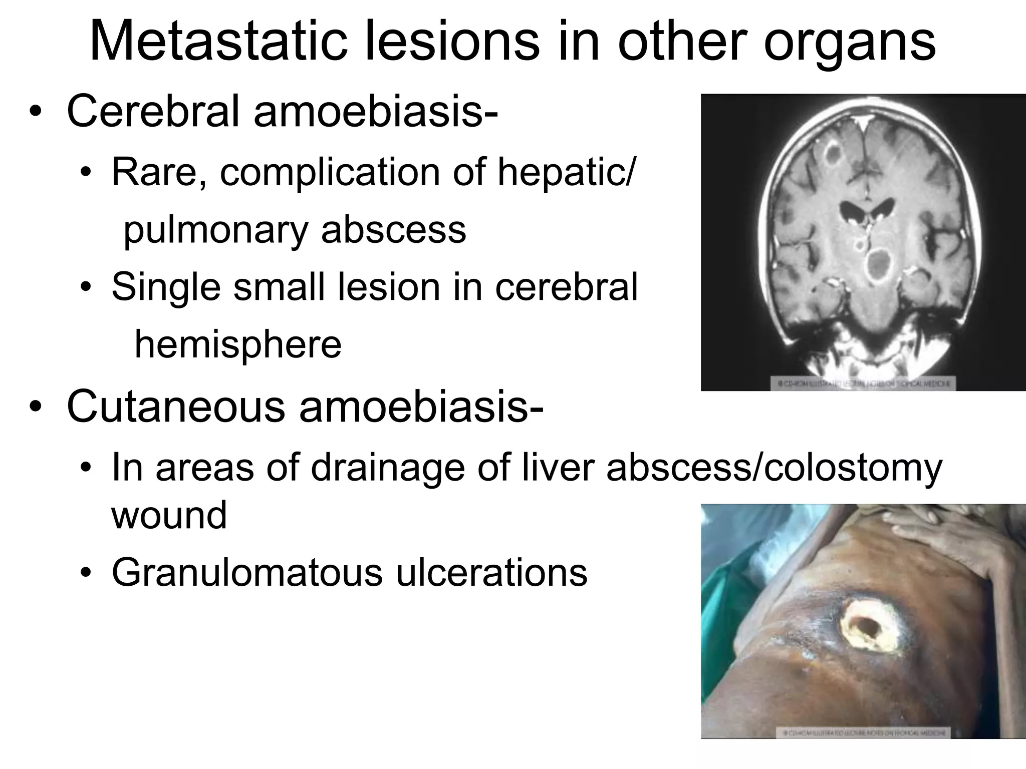 Amoebiasis | PPTX