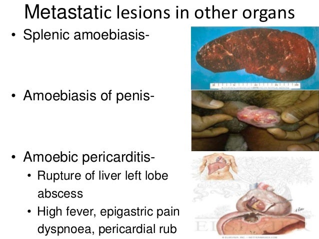 Amoebiasis