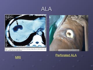 Amoebiasis presentation of microbiology ppt | PPT