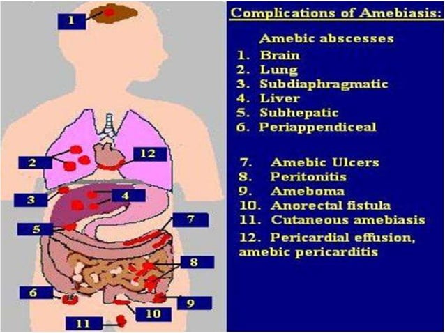 Amoebiasis clinical features