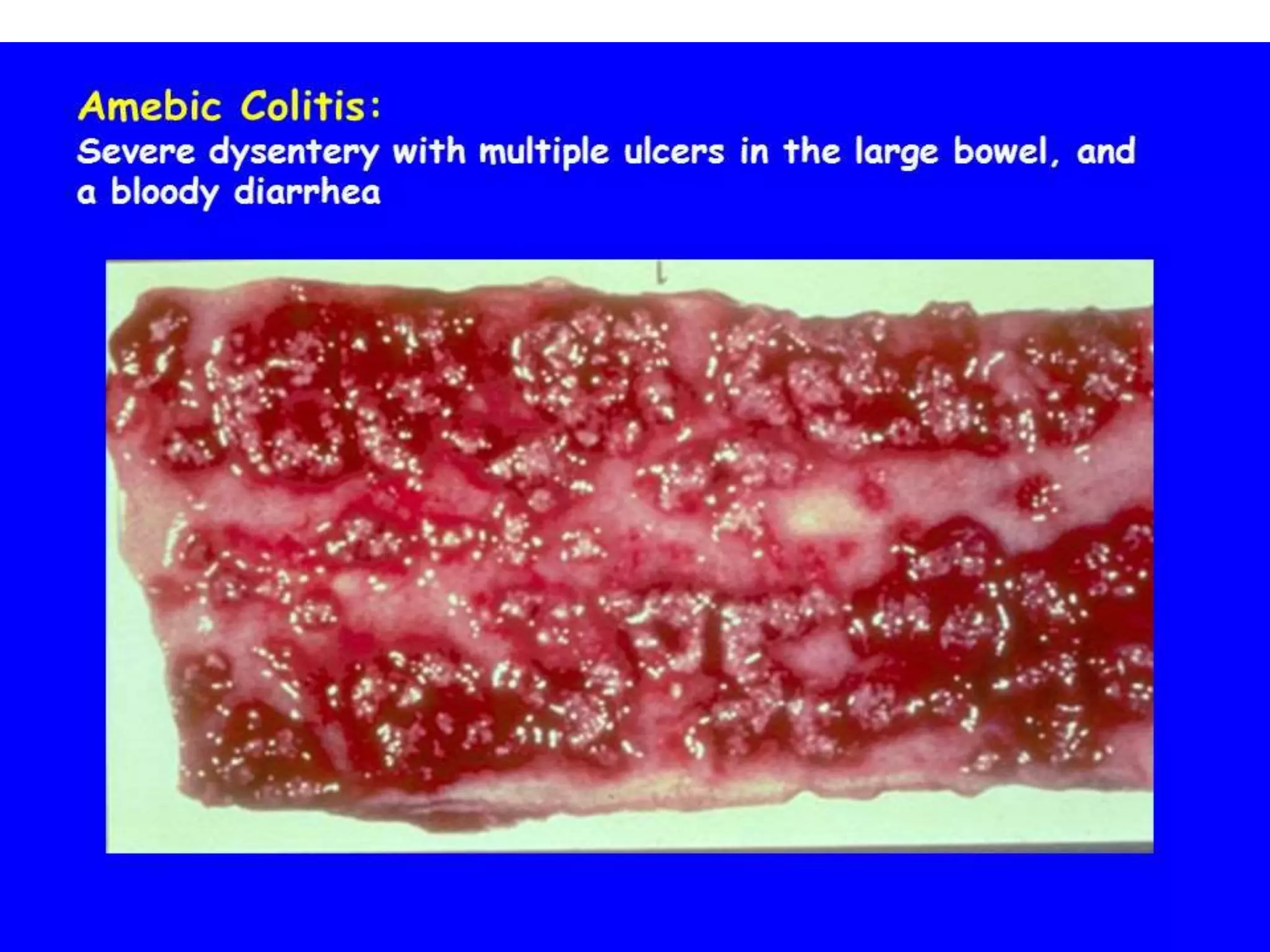 Amoebic colitis | PPTX