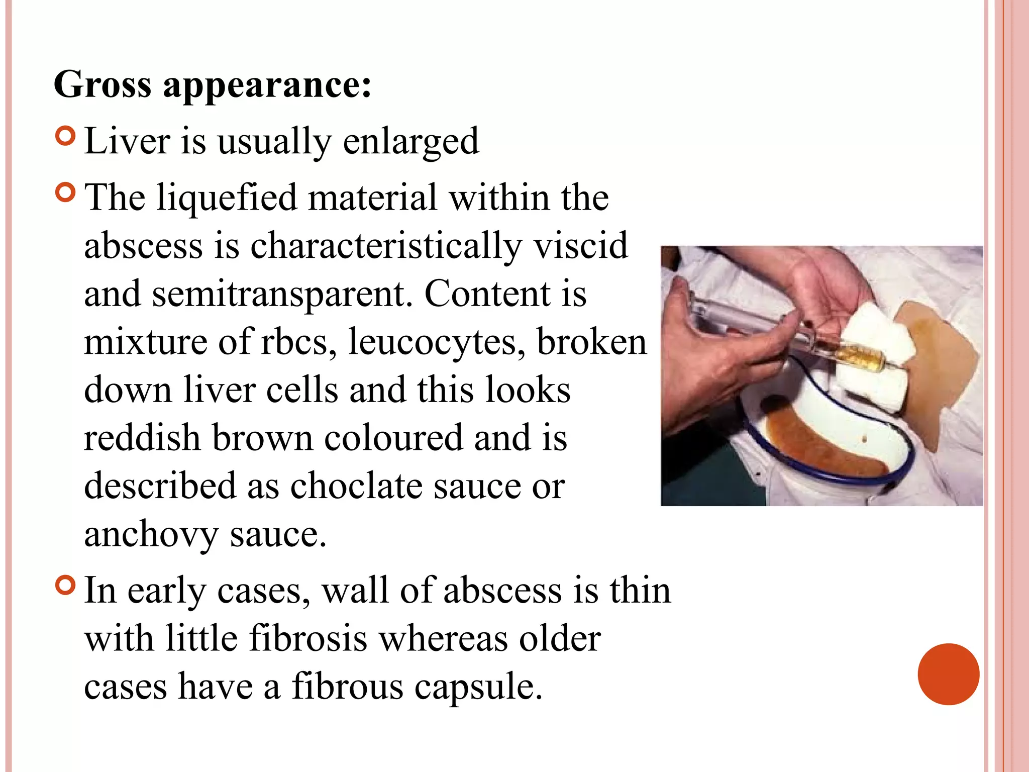Amoebic liver abscess.ppt