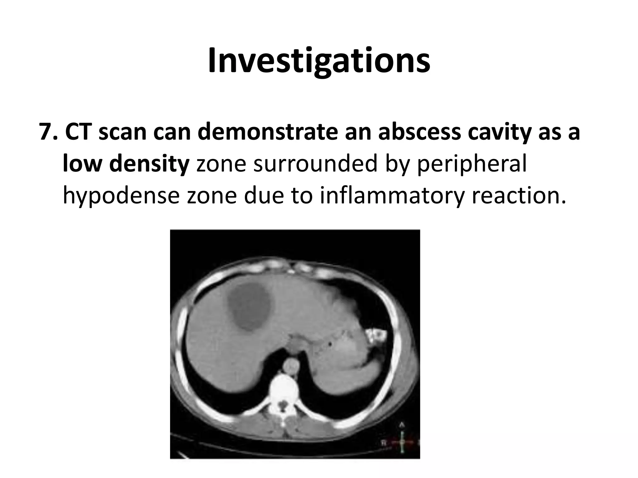 AMOEBIC LIVER ABSCESS | PPTX